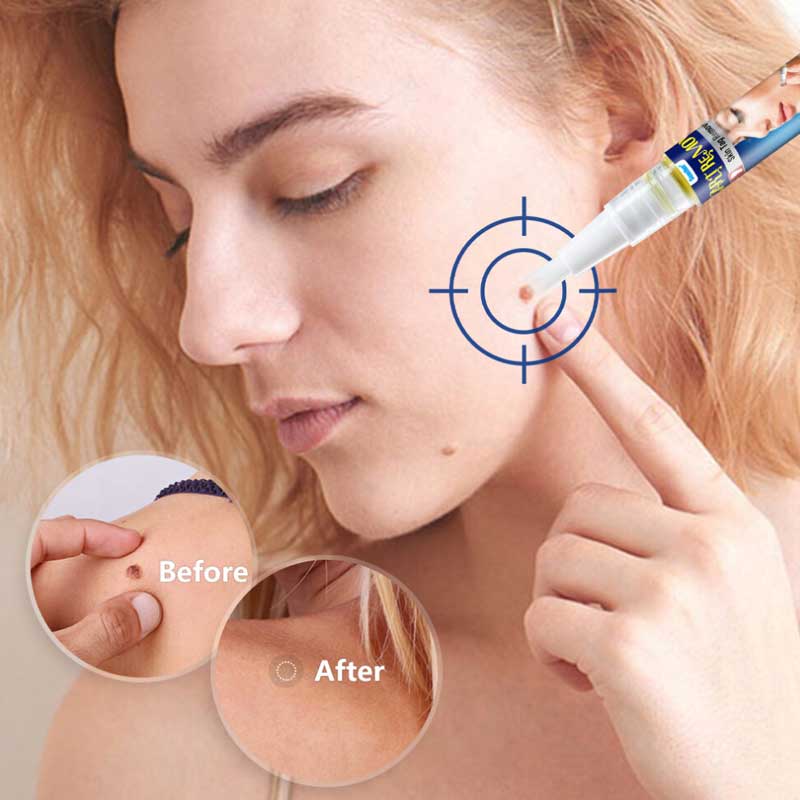 Skin Warts & Corns Treatment in Punjabi Bagh by Dr Vijay Singhal