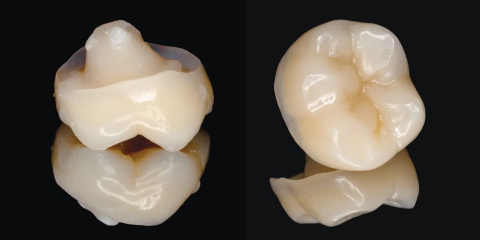 Endocrowns as the Gold Standard - Zenith Dental & Skin Clinic in ...